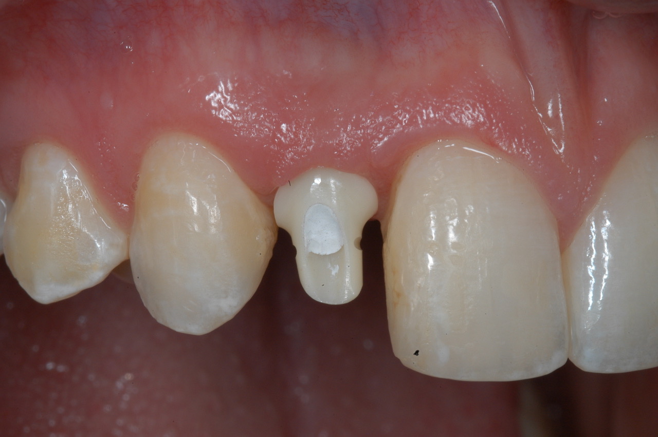 Services: Single Tooth Implants | Brisbane Prosthodontics