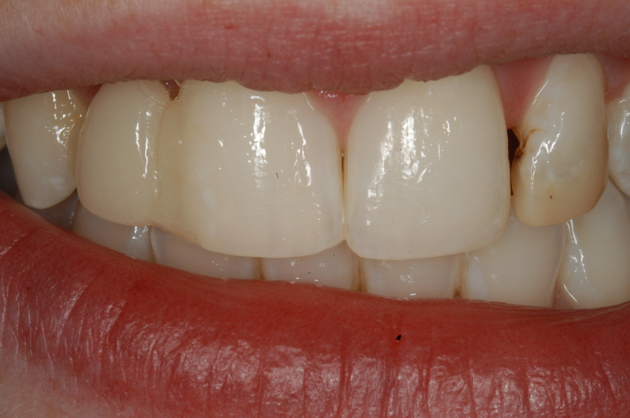 Services: Single Tooth Implants | Brisbane Prosthodontics