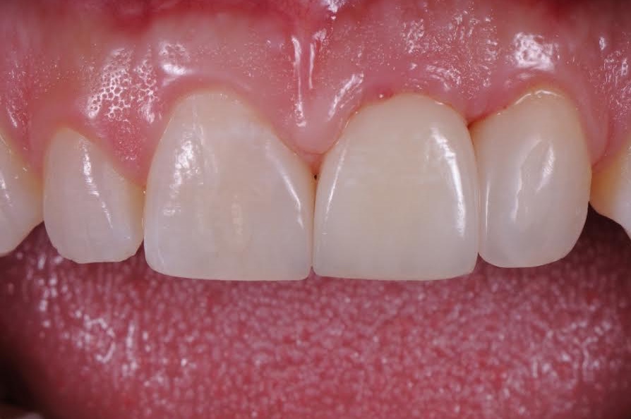 Services: Single Tooth Implants | Brisbane Prosthodontics