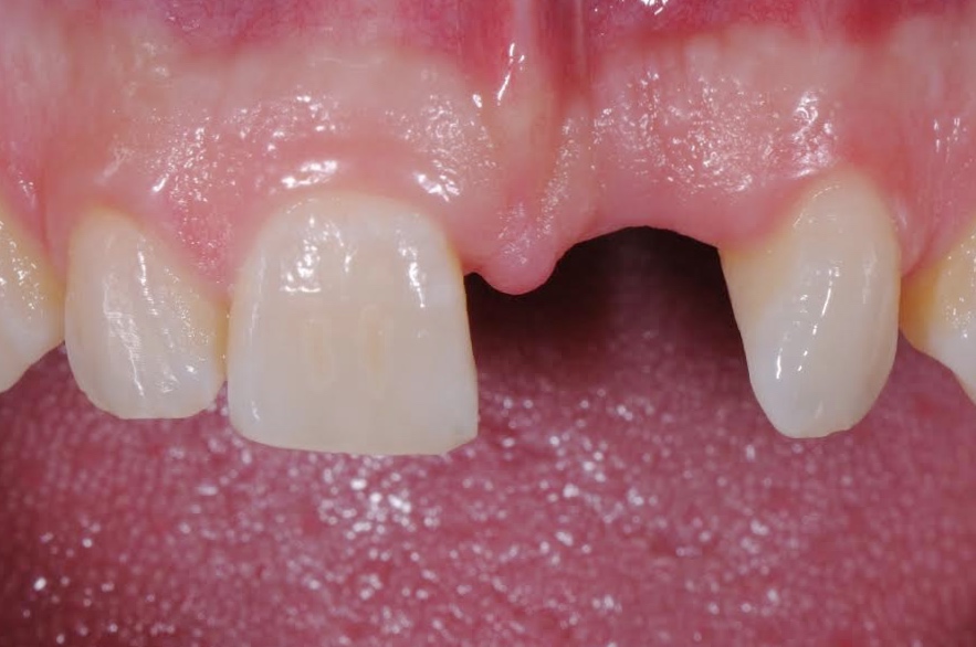Services: Single Tooth Implants | Brisbane Prosthodontics