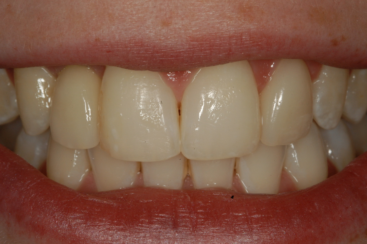 Services: Single Tooth Implants | Brisbane Prosthodontics