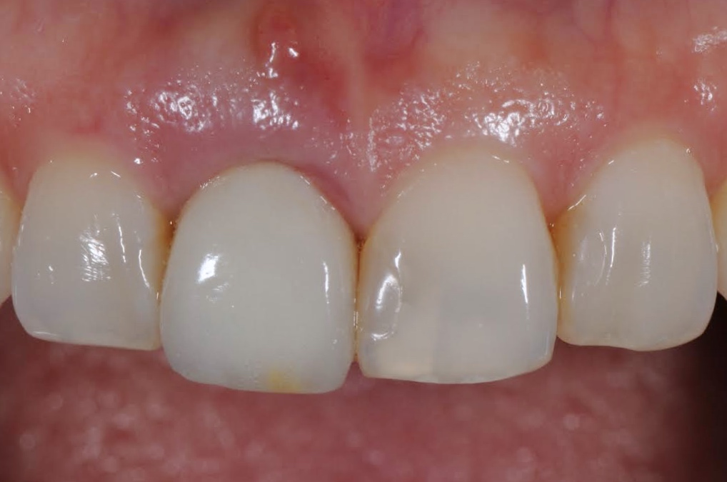 Services: Single Tooth Implants | Brisbane Prosthodontics