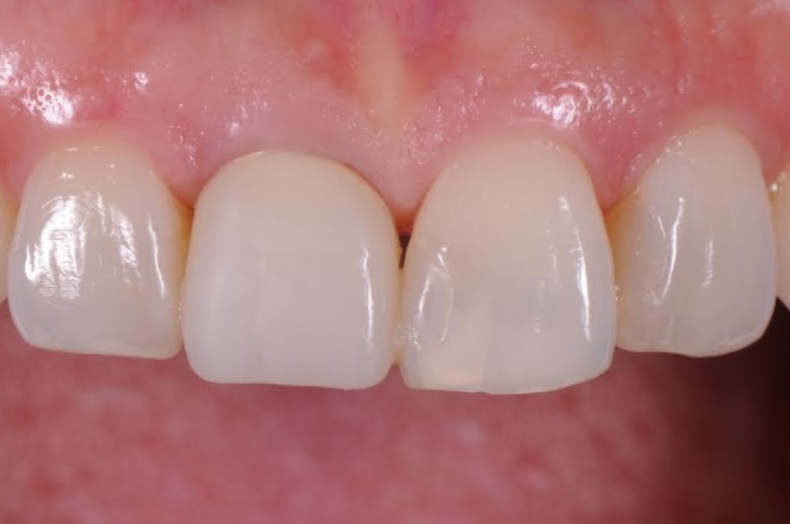 Services: Single Tooth Implants | Brisbane Prosthodontics