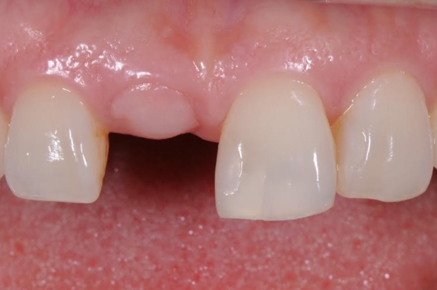 Services: Single Tooth Implants | Brisbane Prosthodontics