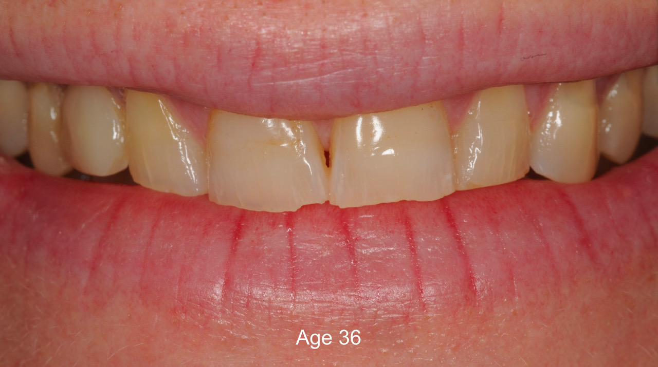 Services: Treatment of Erosion | Brisbane Prosthodontics