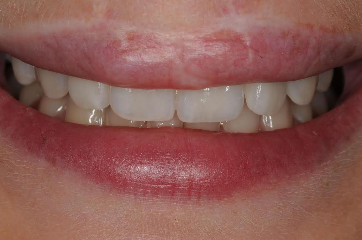 Services: Cleft Palate | Brisbane Prosthodontics