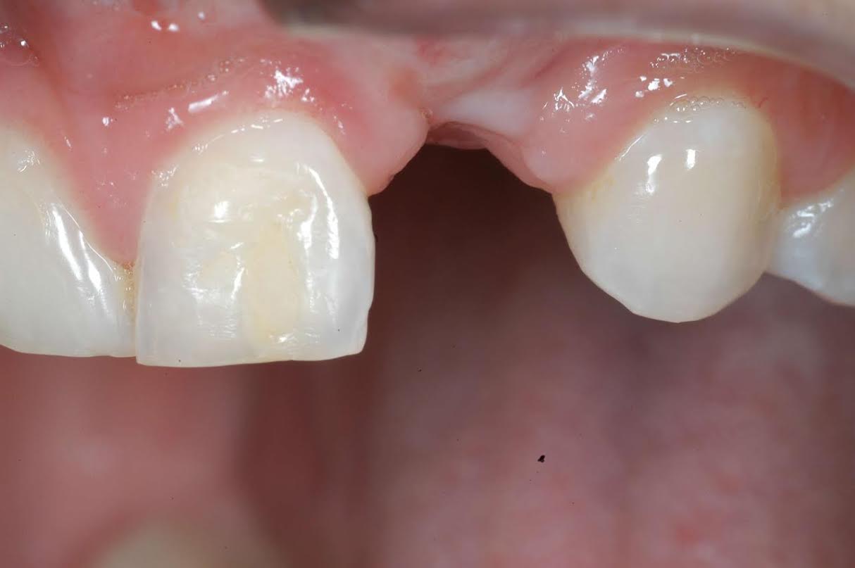 Services: Cleft Palate | Brisbane Prosthodontics