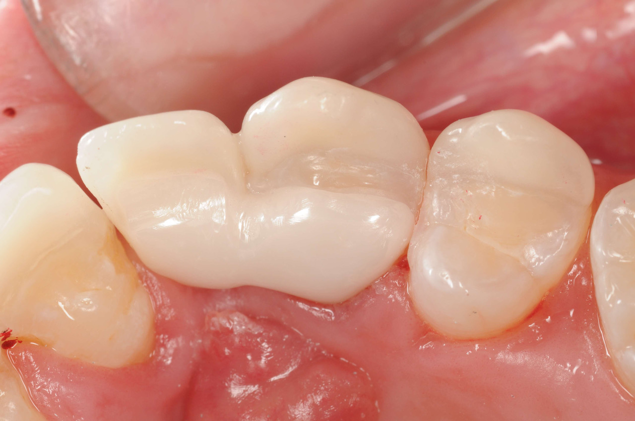 Services: Cleft Palate | Brisbane Prosthodontics