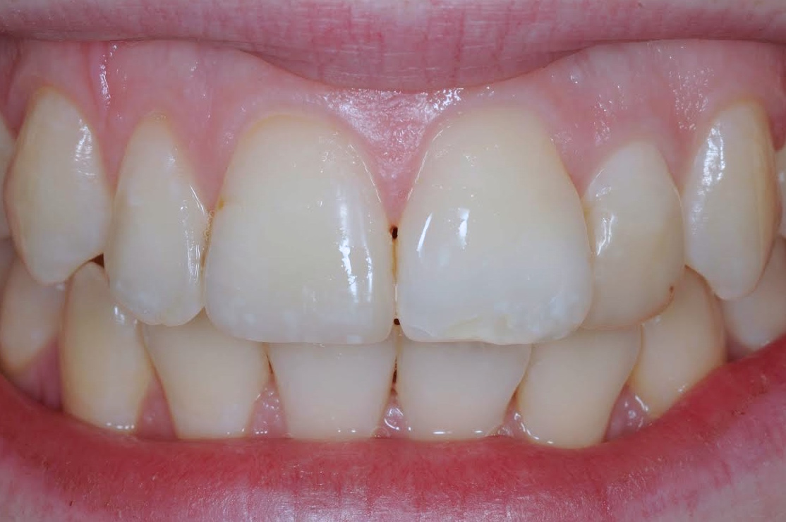 Services: Single Tooth Whitening | Brisbane Prosthodontics