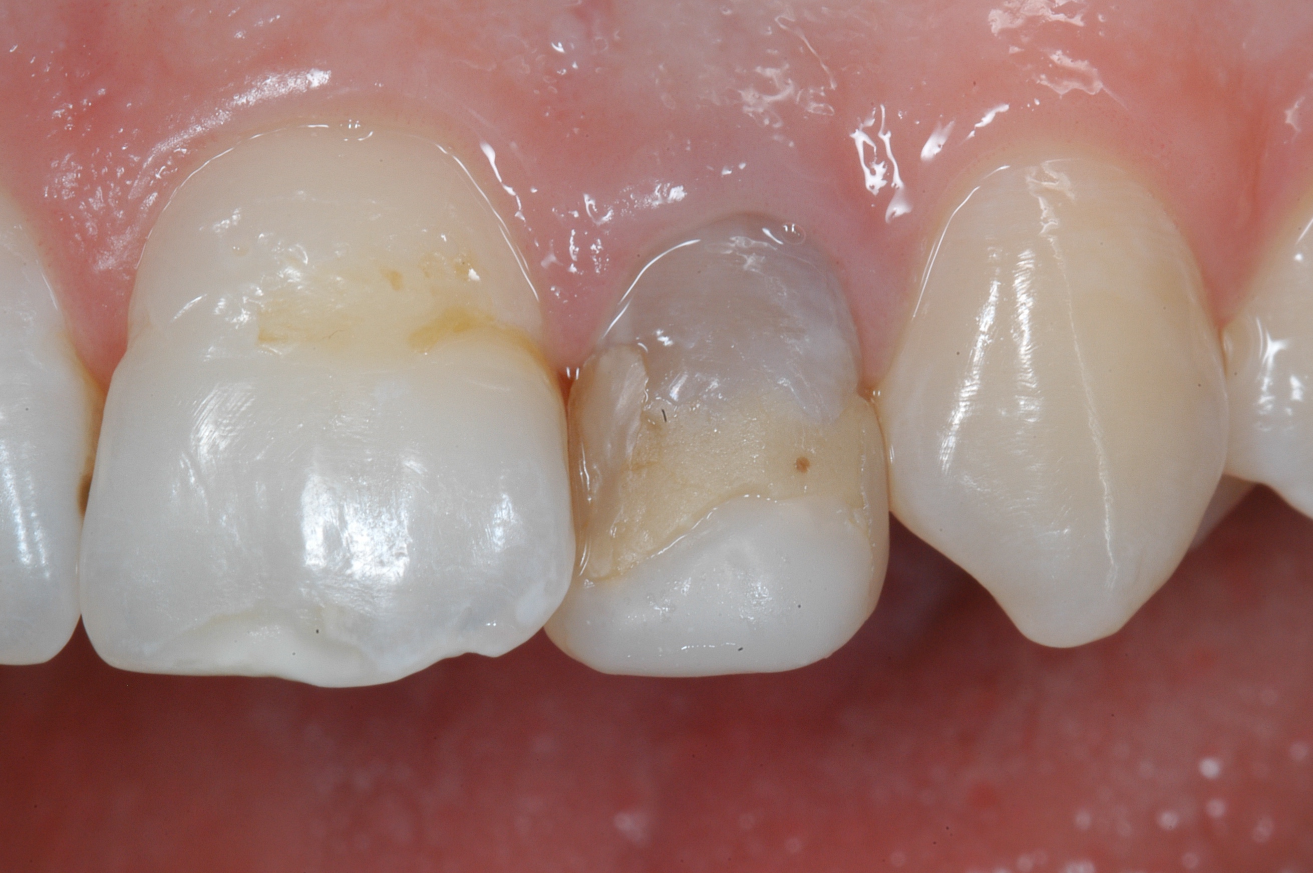 Services: Single Tooth Whitening | Brisbane Prosthodontics