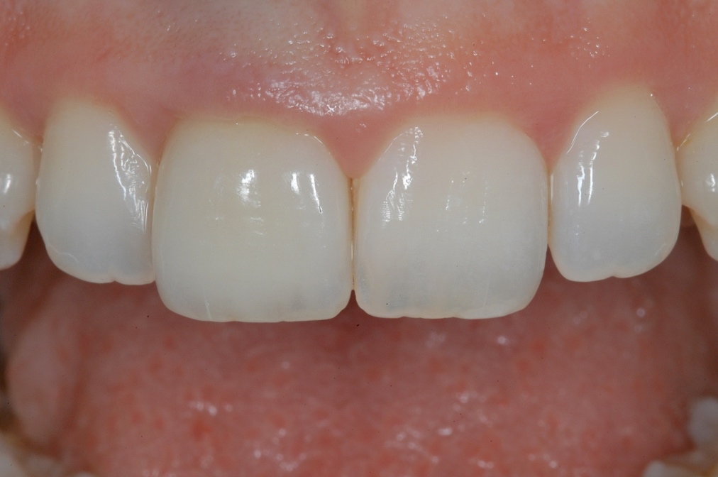 Services: Dark and Discoloured Single Teeth | Brisbane Prosthodontics