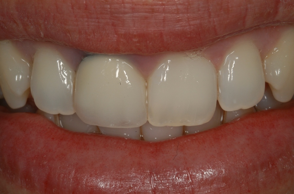 Services: Dark and Discoloured Single Teeth | Brisbane Prosthodontics