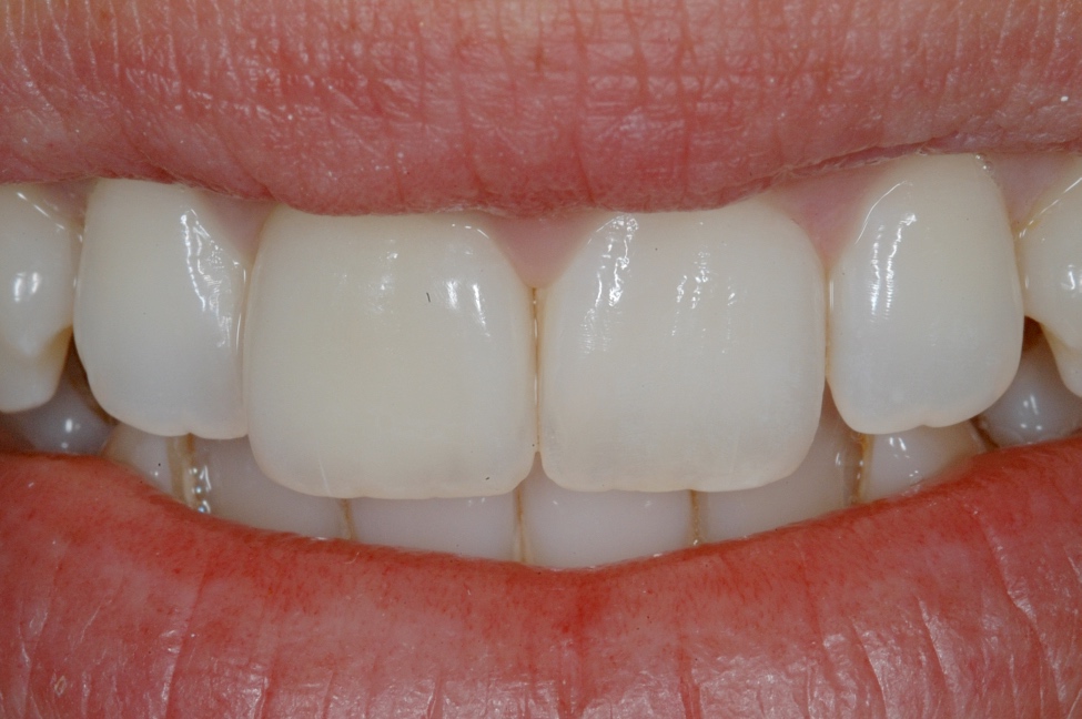 Services: Dark and Discoloured Single Teeth | Brisbane Prosthodontics