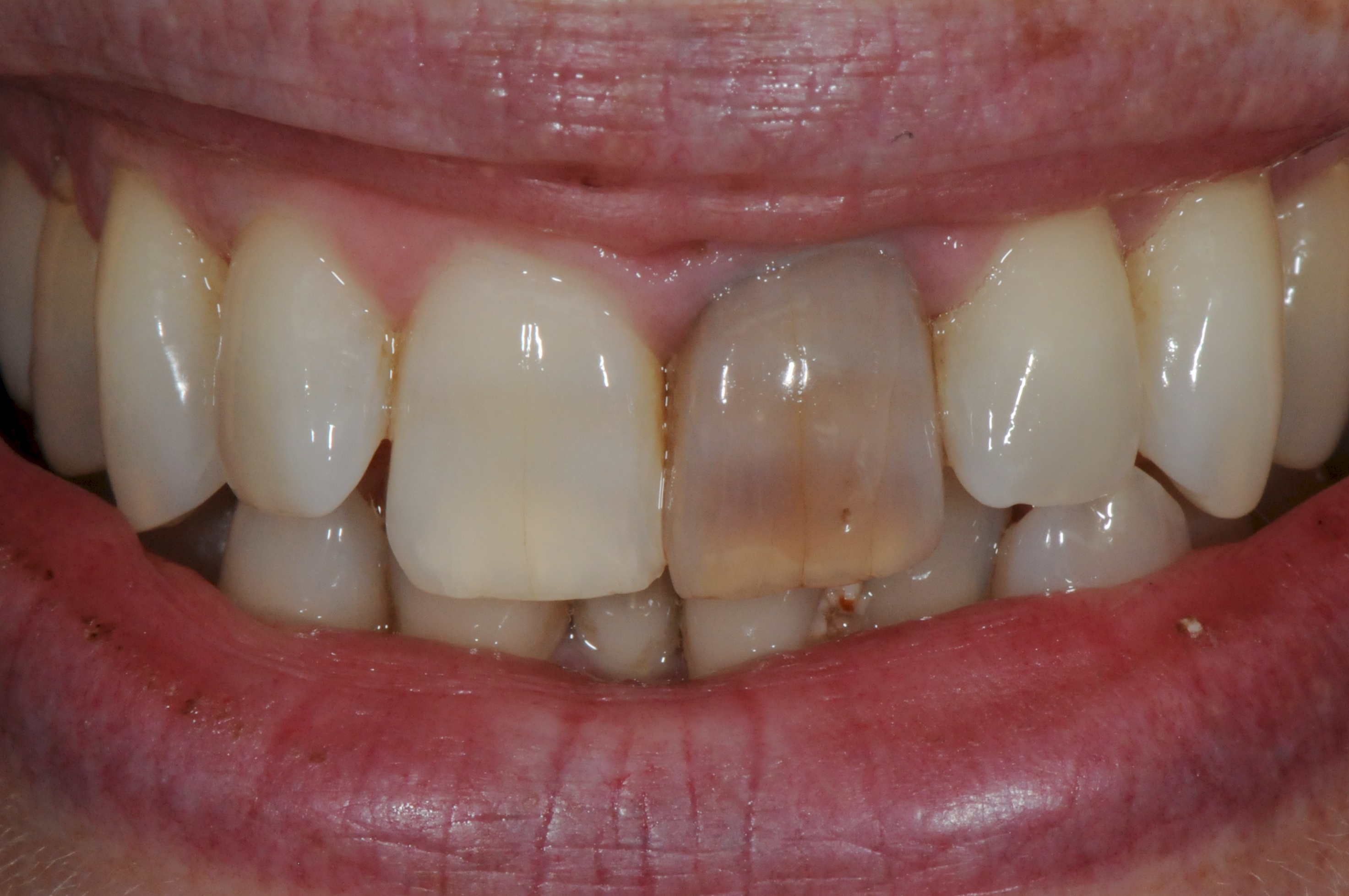 Services: Dark and Discoloured Single Teeth | Brisbane Prosthodontics