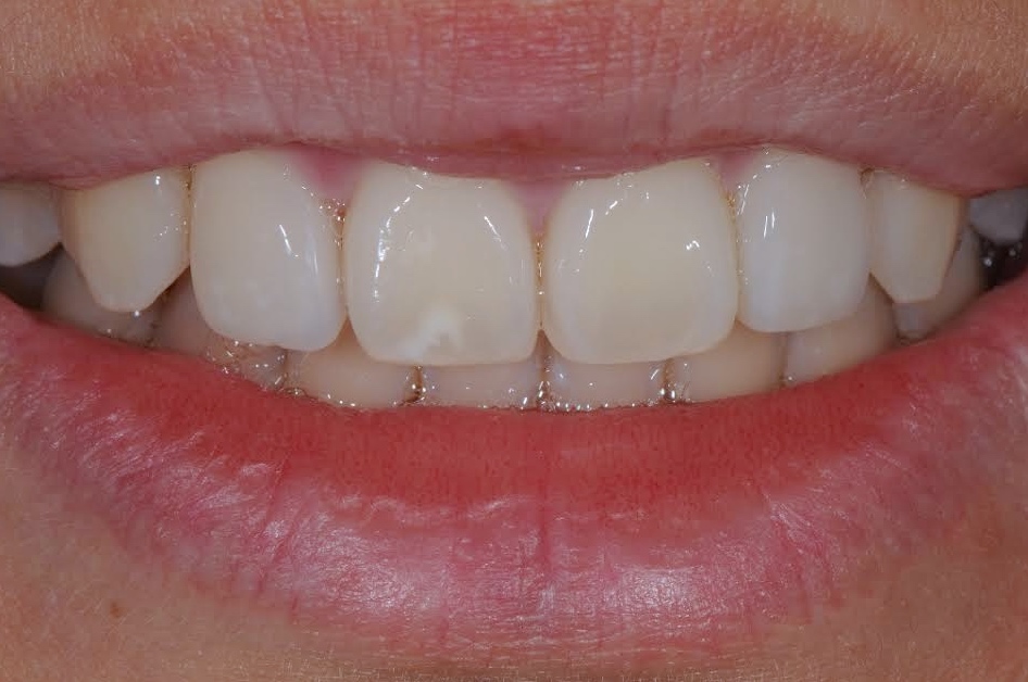 Services: Peg Laterals | Brisbane Prosthodontics