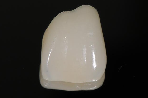 Services: Porcelain Crowns | Brisbane Prosthodontics