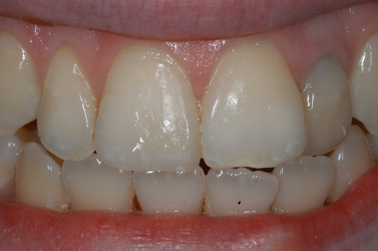 Services: Nice Composite Restorations | Brisbane Prosthodontics