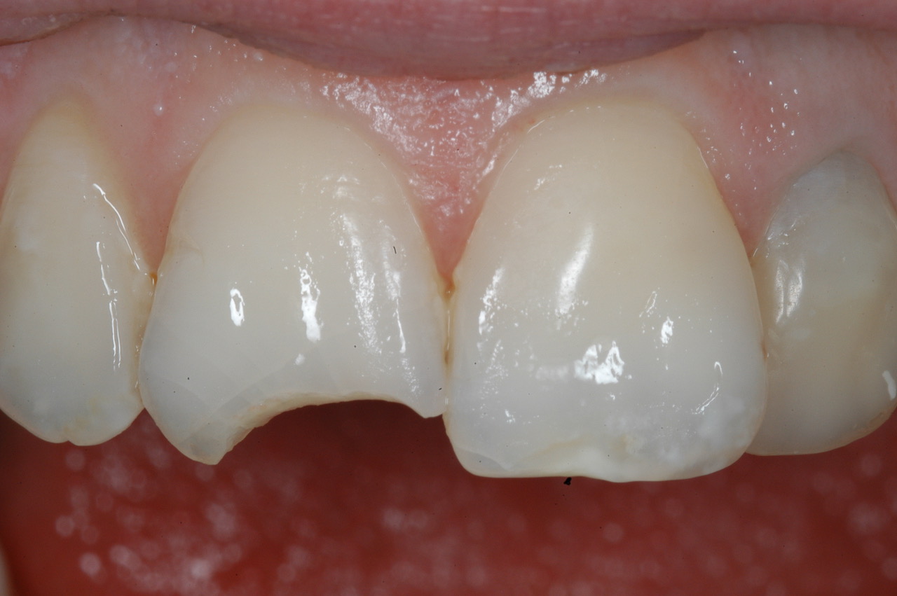 Services: Nice Composite Restorations | Brisbane Prosthodontics