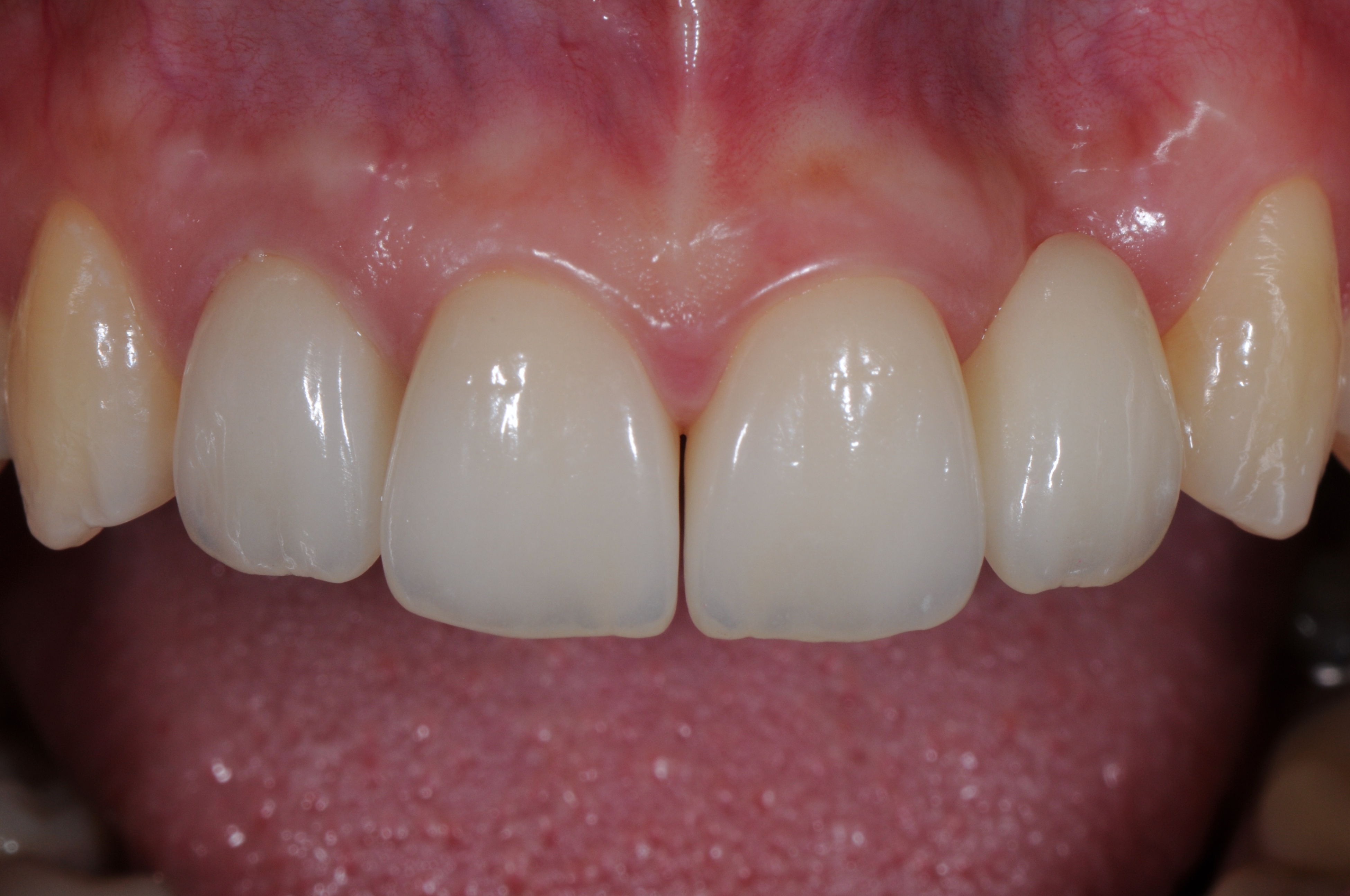 Services: Perfect Porcelain Crowns | Brisbane Prosthodontics