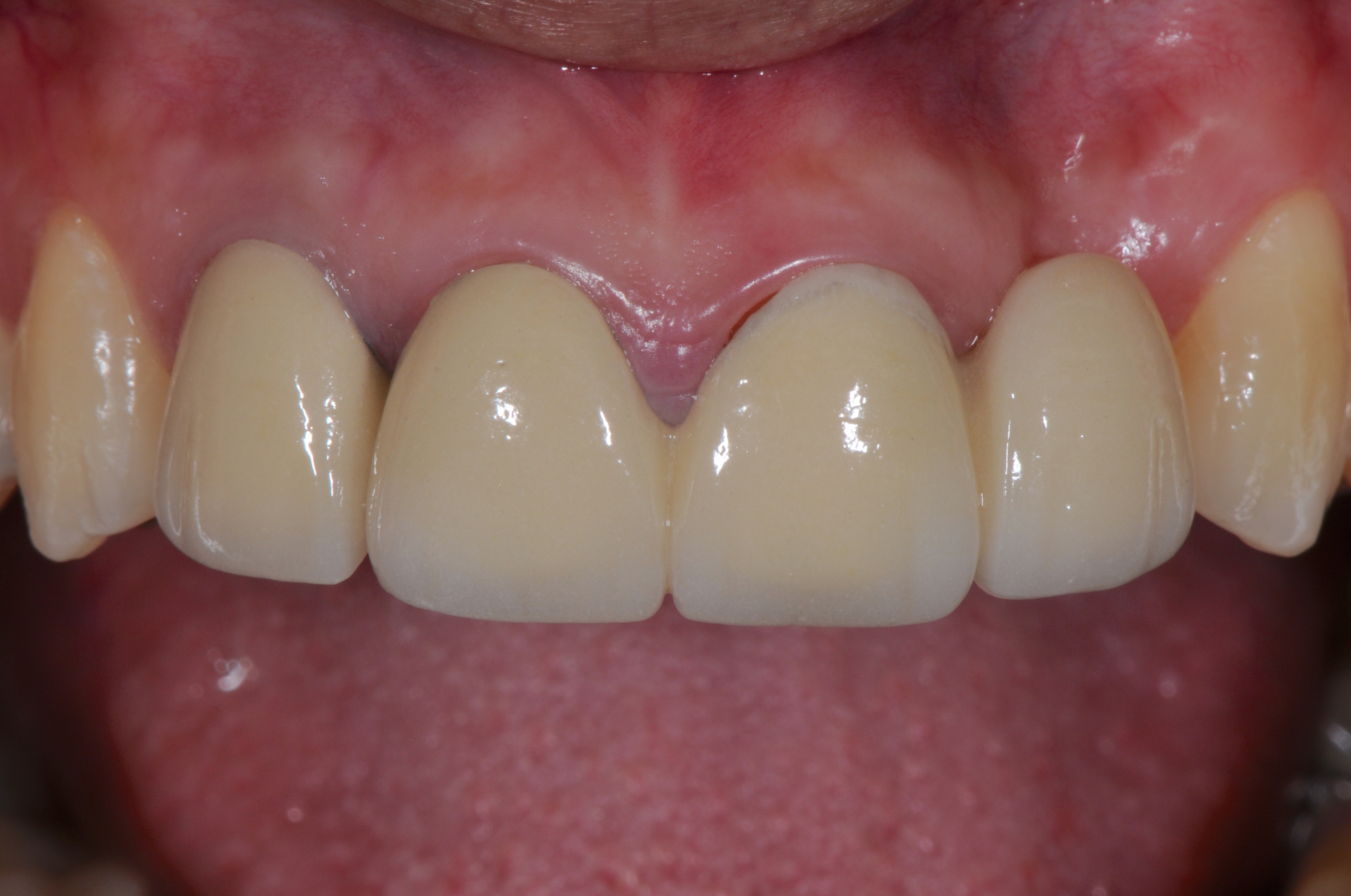 Services: Perfect Porcelain Crowns | Brisbane Prosthodontics
