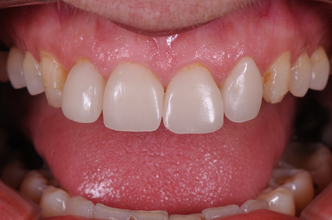Services: Poor Porcelain Crowns | Brisbane Prosthodontics