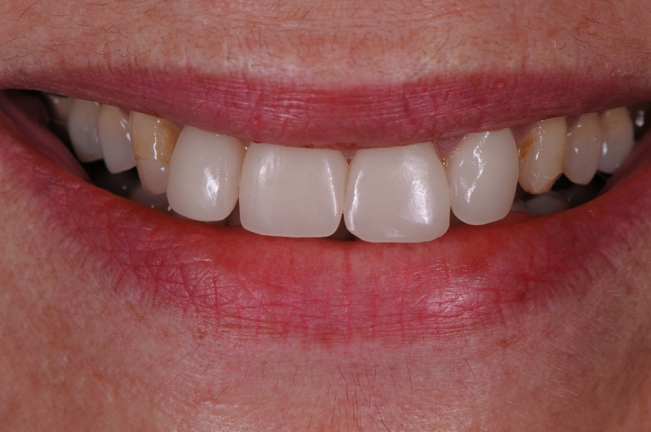 Services: Poor Porcelain Crowns | Brisbane Prosthodontics