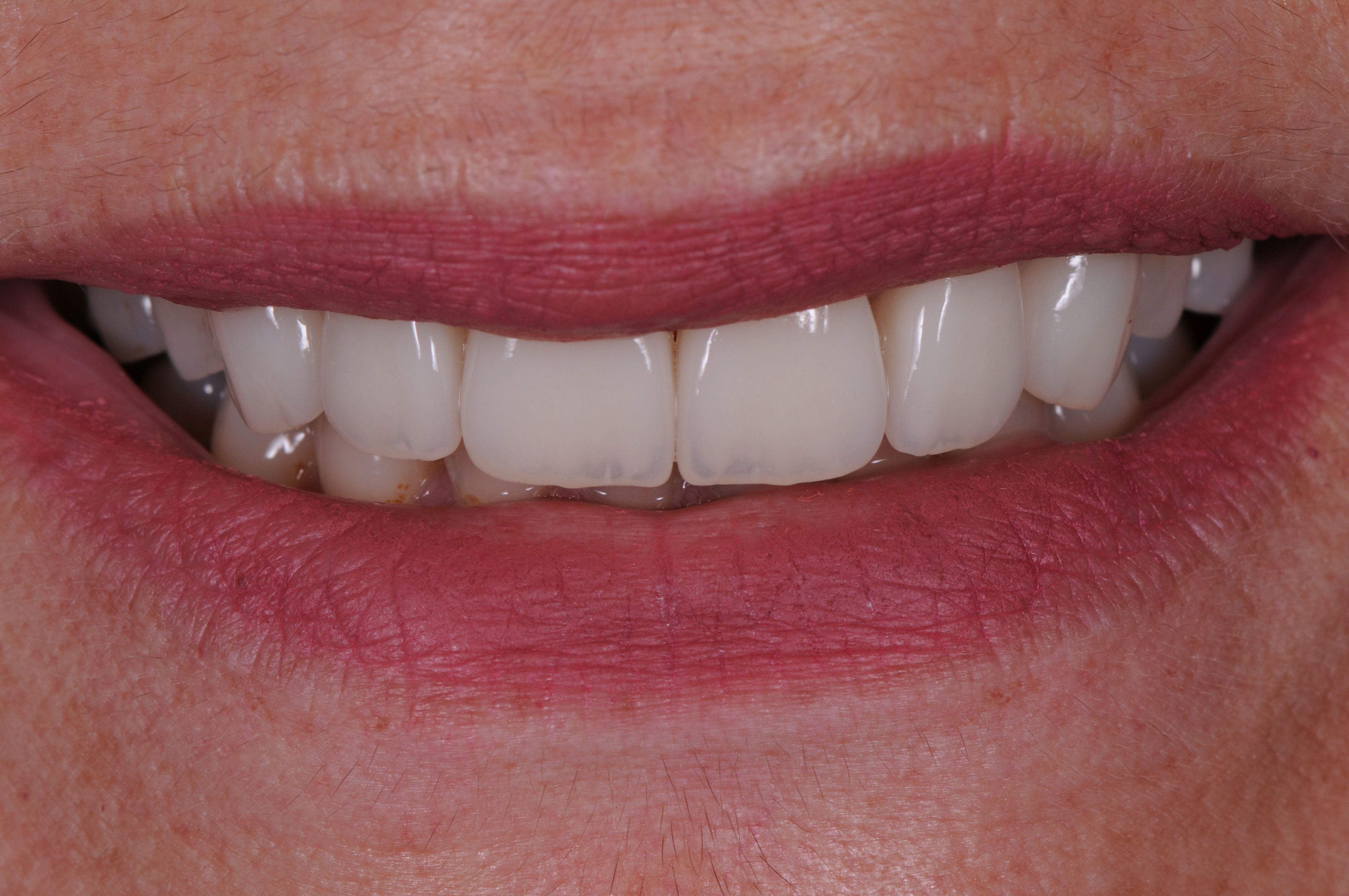 Services: Poor Porcelain Crowns | Brisbane Prosthodontics