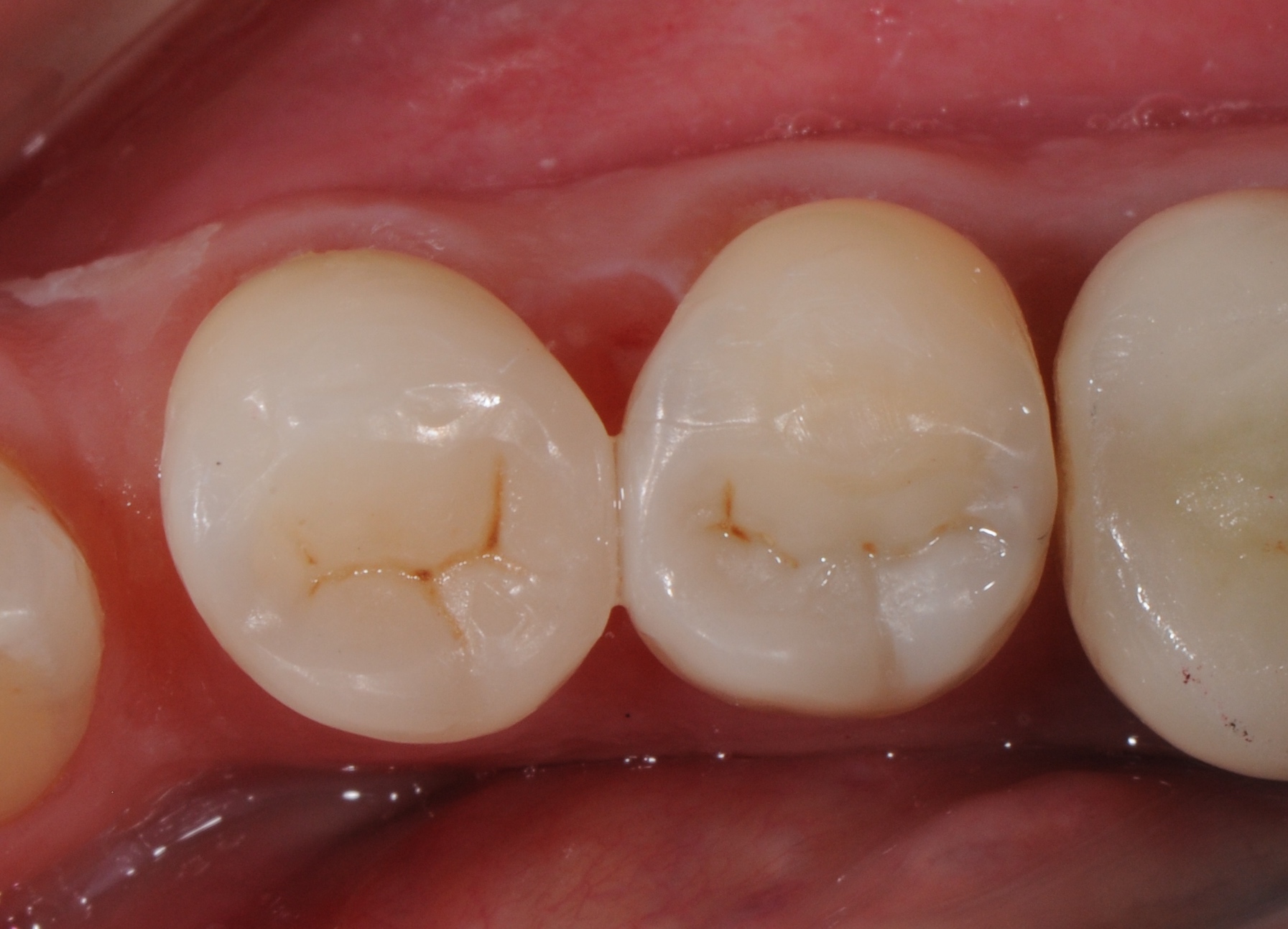 Services: Poor Composite Restorations | Brisbane Prosthodontics