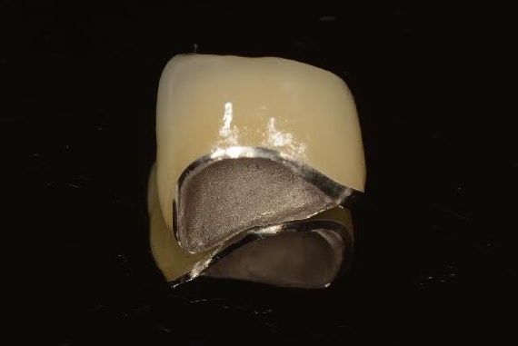 Services: PFM Crowns | Brisbane Prosthodontics