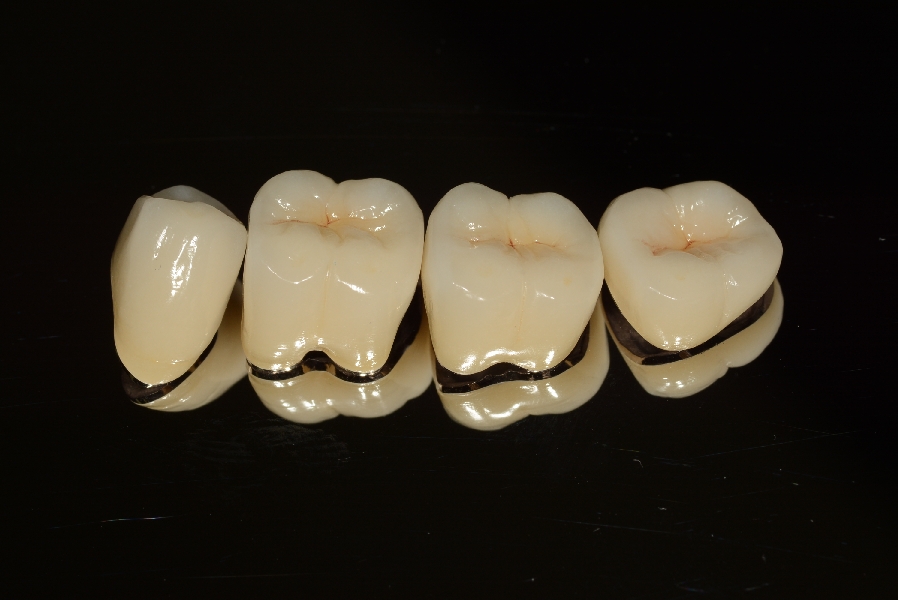 Services: PFM Crowns | Brisbane Prosthodontics