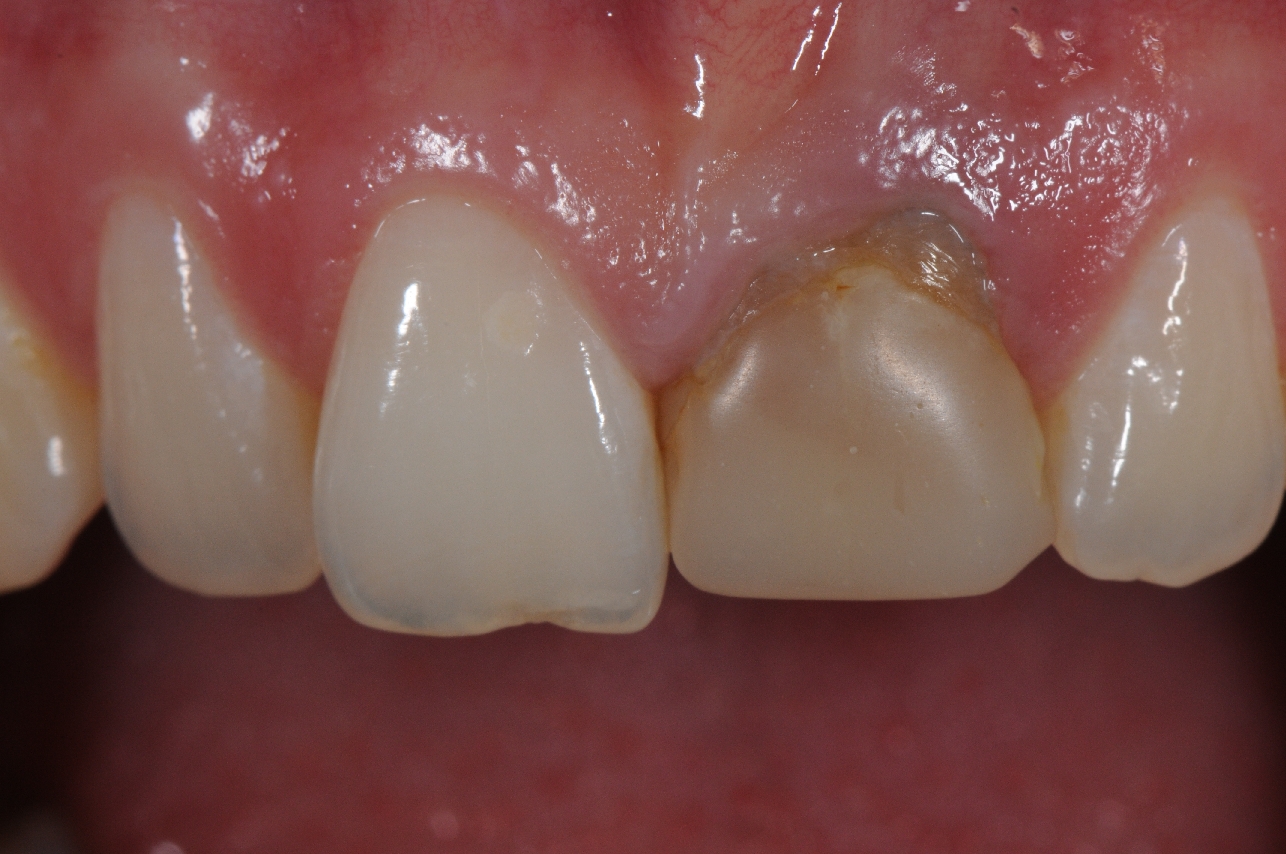 Services: Nice Porcelain Crowns | Brisbane Prosthodontics