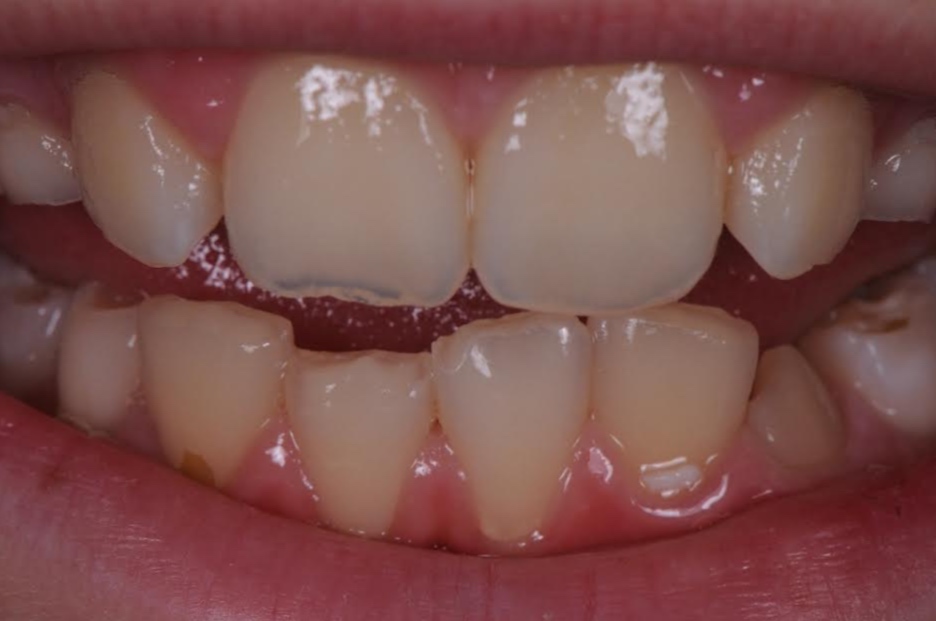 Services: Trauma and Chipped Teeth | Brisbane Prosthodontics