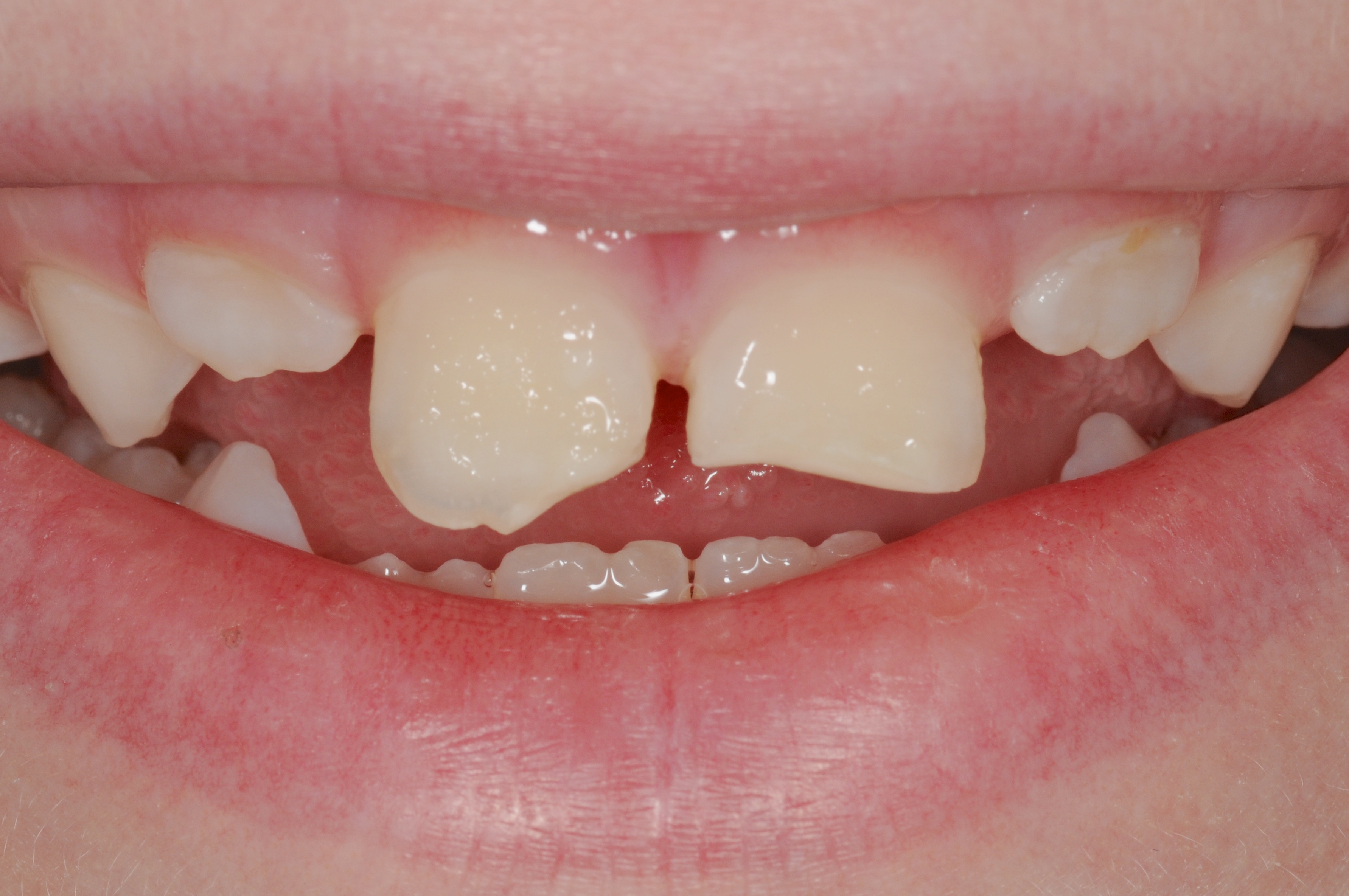Services: Trauma and Chipped Teeth | Brisbane Prosthodontics