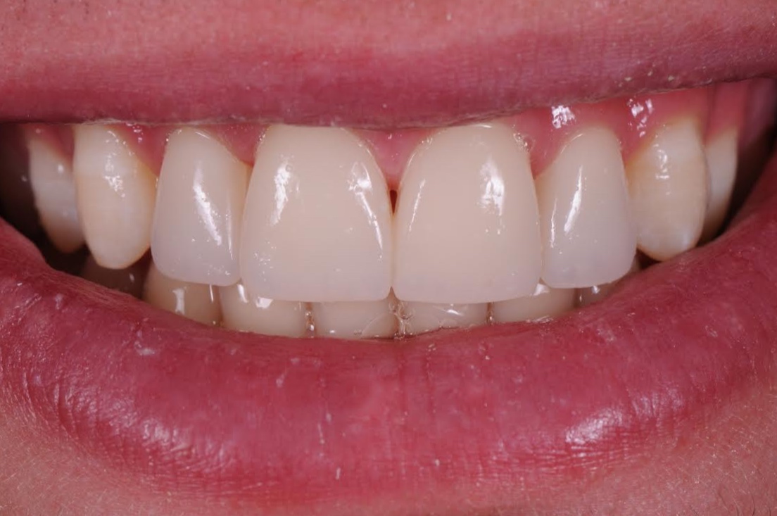 Services: Composite Buildups | Brisbane Prosthodontics