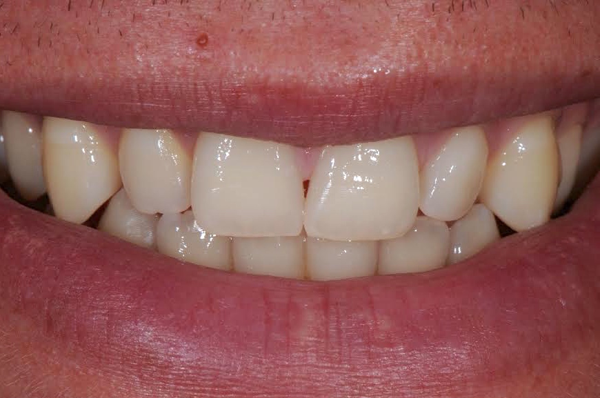 Services: Composite Buildups | Brisbane Prosthodontics