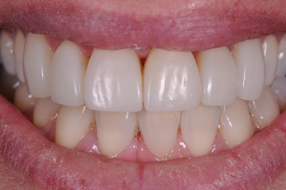 Services: Composite Buildups | Brisbane Prosthodontics