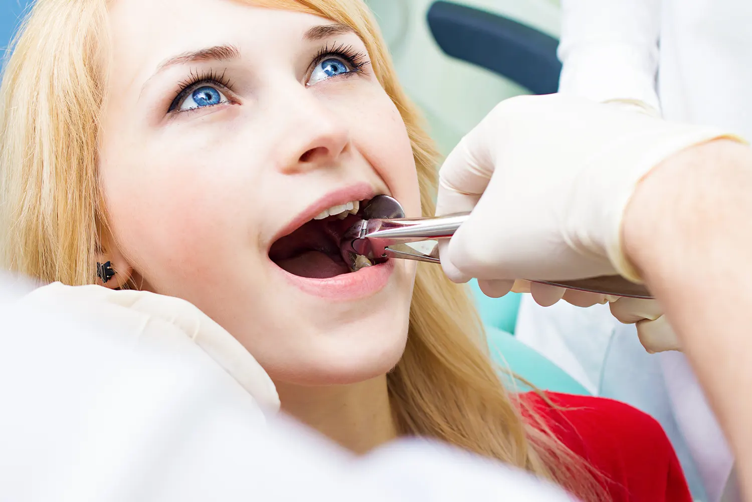 How to Stop Bleeding After Wisdom Tooth Extraction