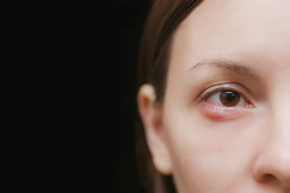 An Integrative Approach to Recurring Stye Infections: Testing, Dietary ...