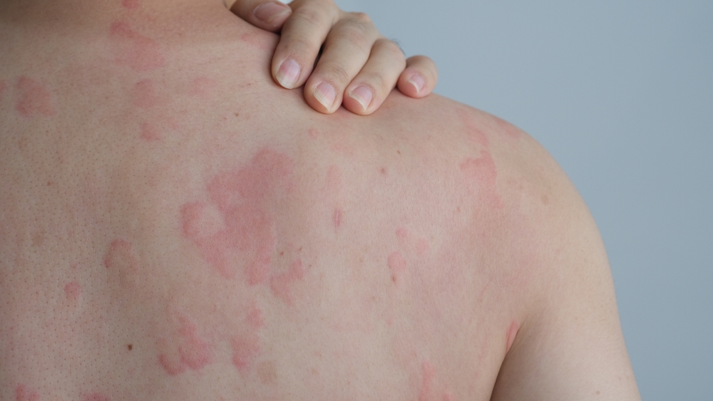 Hives In Children