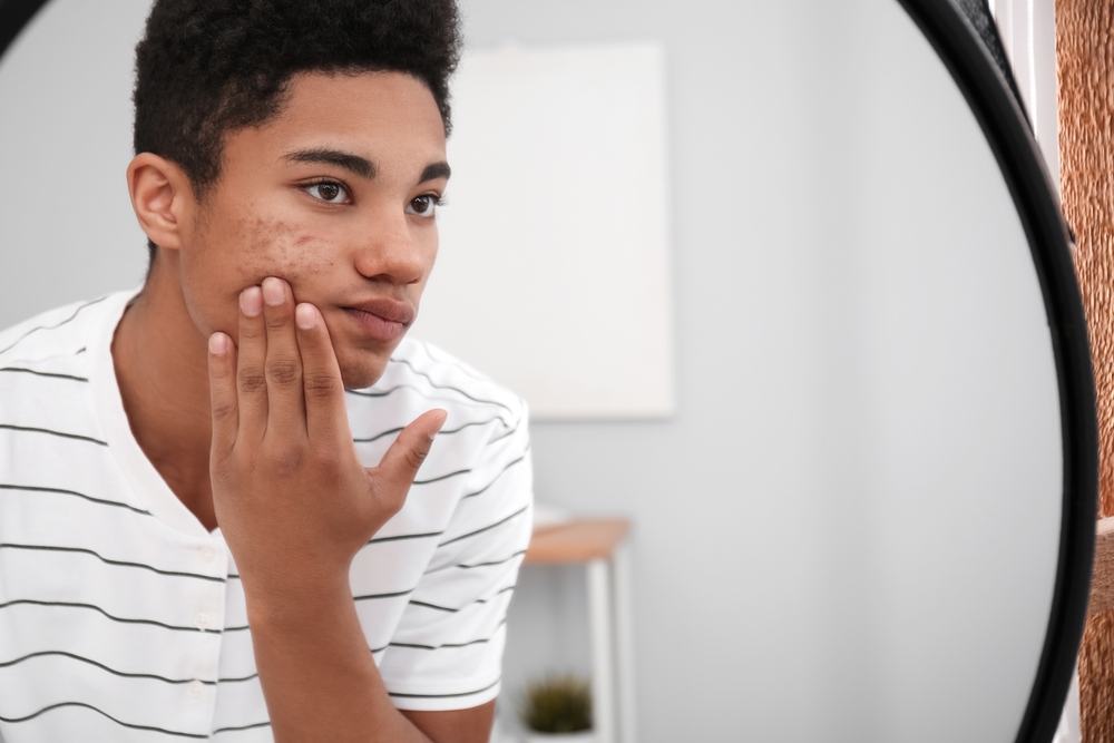 The Gut-Based Approach to Healing Your Acne