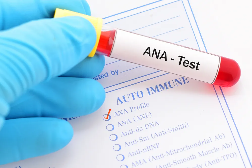 Which Patients Should You Run An ANA Test On?
