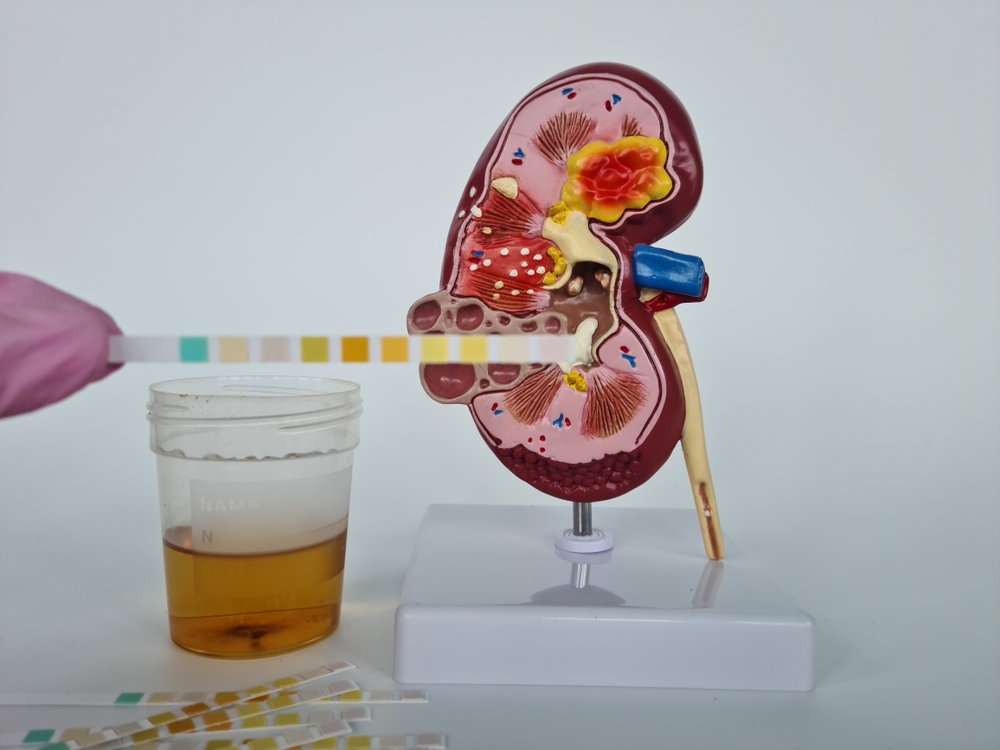 The Value of Urinalysis in Functional Medicine: A Tool for ...