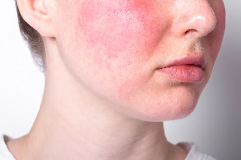 Behind the Redness: Decoding Malar Rash vs Rosacea
