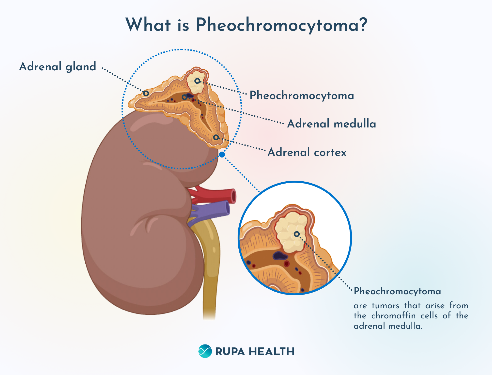 A Functional Medicine Approach to Pheochromocytoma