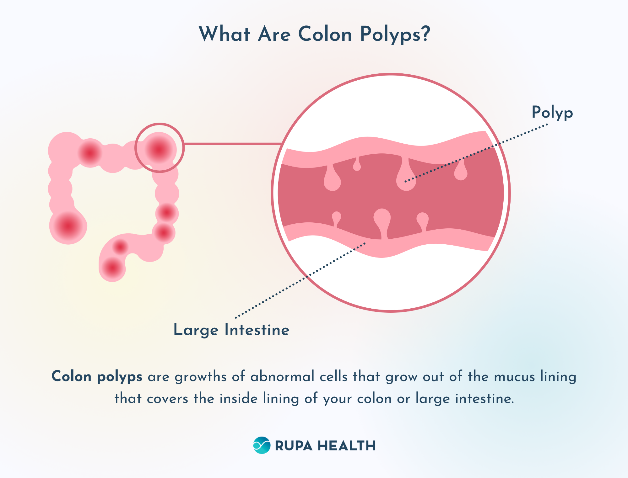 A Functional Medicine Approach to Colon Polyps