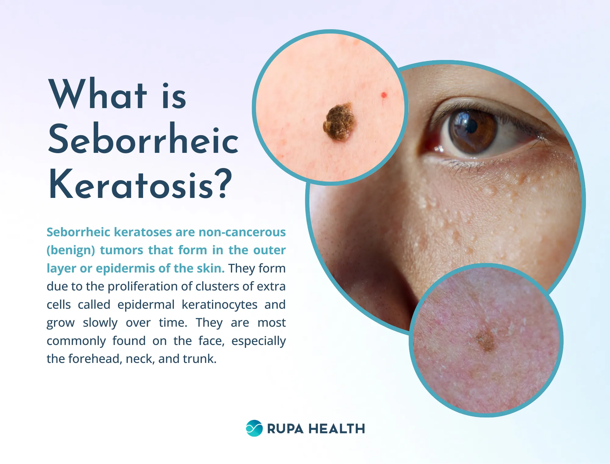 A Functional Medicine Approach to Seborrheic Keratosis