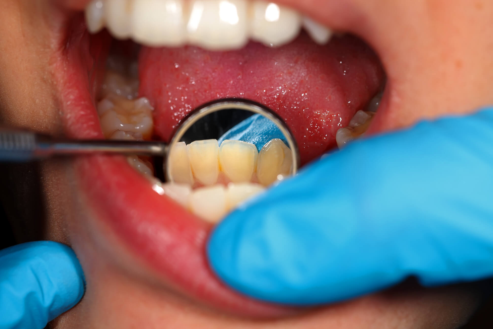 Dentist in North Lauderdale | What Are the Symptoms of Tooth Decay?