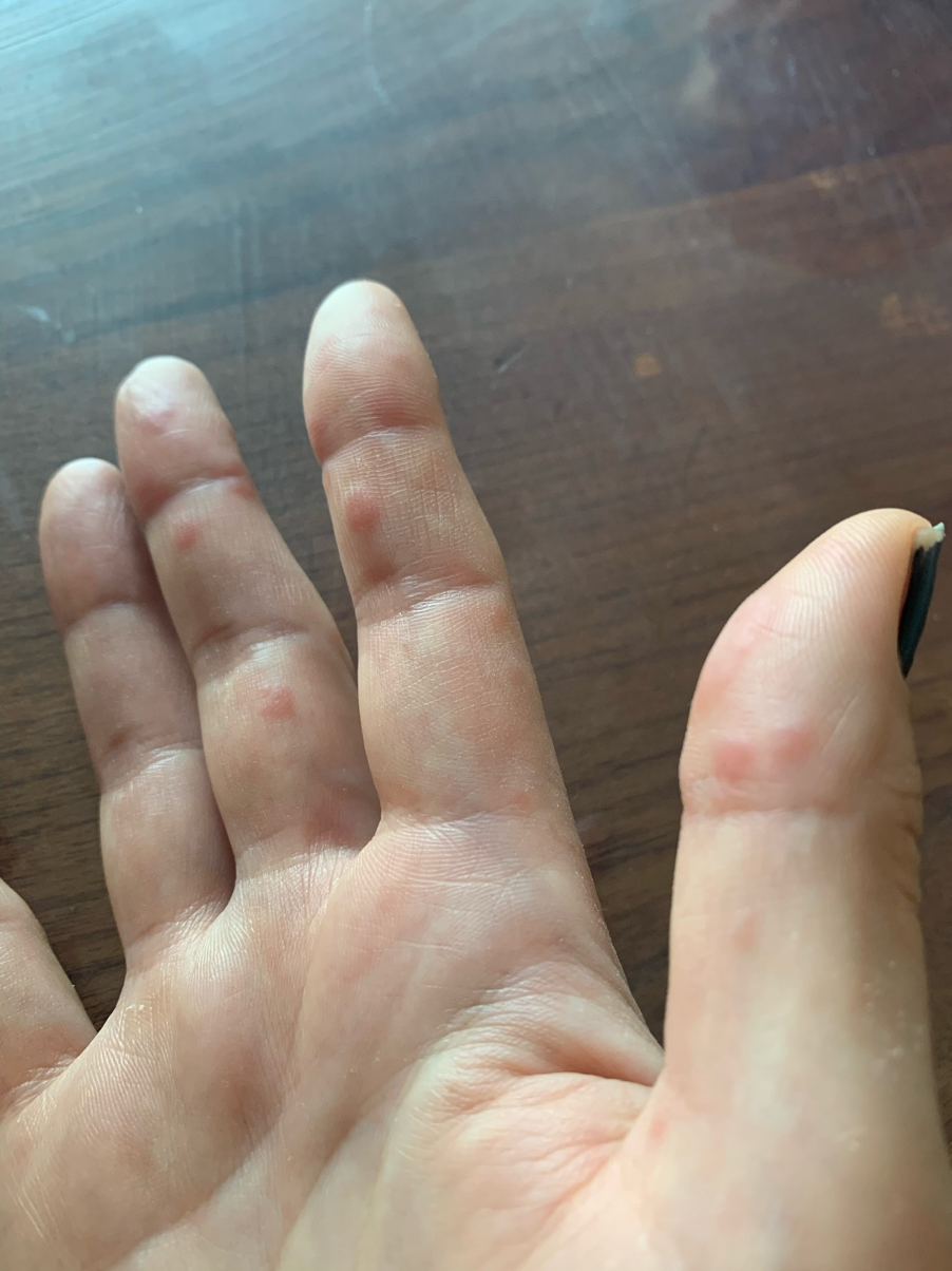 Is My Skin Rash A COVID 19 Symptom 