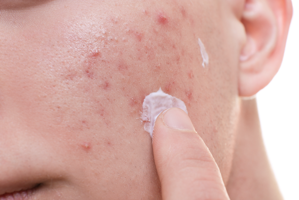 Acne vulgaris of jeugdpuistjes | Laserkliniek
