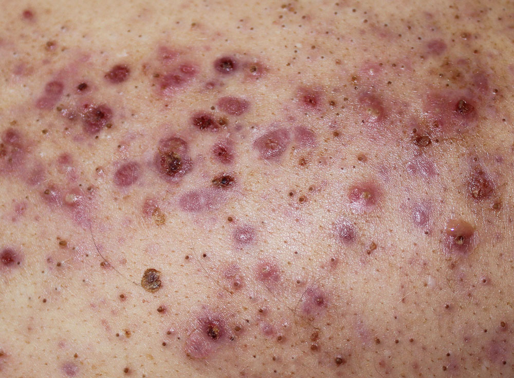 Acne conglobata omschrijving | Laserkliniek